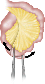 How I Do It: Side-to-Side Isoperistaltic Strictureplasty for Extensive ...