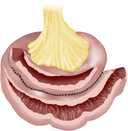 How I Do It: Side-to-Side Isoperistaltic Strictureplasty for Extensive ...