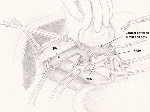 Cattell-Braasch Maneuver Combined with Artery-First Approach for ...