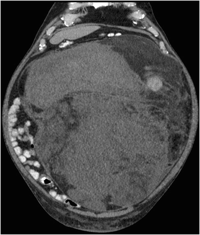 Giant Retroperitoneal Sarcoma | SpringerLink