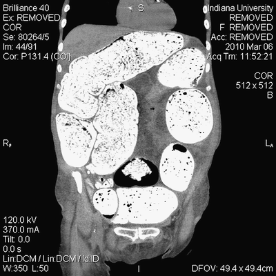 Chronic Constipation with Megacolon | SpringerLink