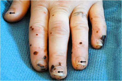 Dermatological Manifestations of Infective Endocarditis | SpringerLink