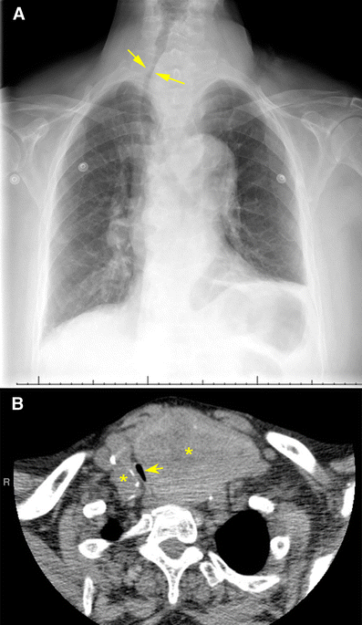 Long-Standing Goiter Causing Acute Airway Compromise | SpringerLink