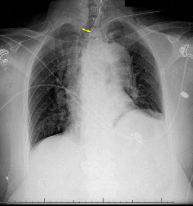 Long-Standing Goiter Causing Acute Airway Compromise | SpringerLink