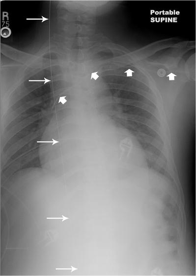 Incidental Discovery of Retained Triple Lumen Catheter Guidewire ...
