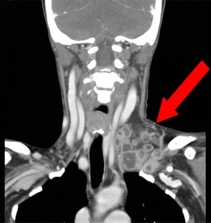 Immune Reconstitution Inflammatory Syndrome Presenting as Mycobacterium ...