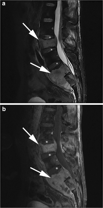 Skeletal Tuberculosis | SpringerLink