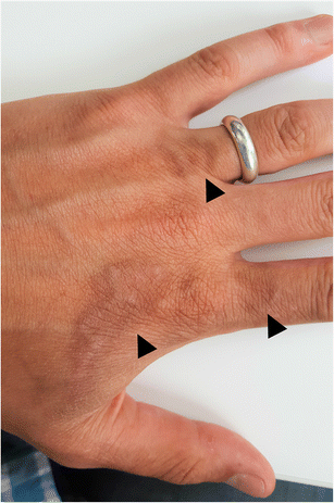 Lime-Induced Phytophotodermatitis | SpringerLink