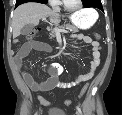 The Comb Sign in Crohn’s Ileocolitis | SpringerLink