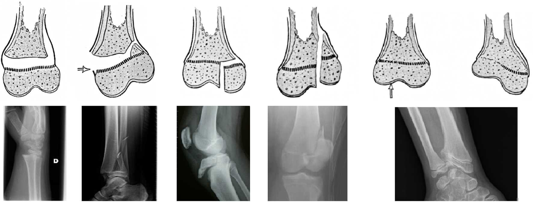 La prognosi dei distacchi epifisari dell’arto inferiore | SpringerLink