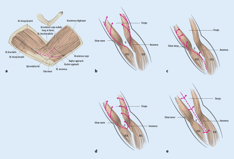 Fracture-pattern-related therapy concepts in distal humeral fractures ...