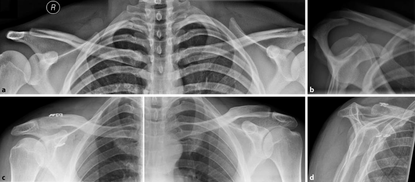 Nonoperative treatment of five common shoulder injuries | SpringerLink