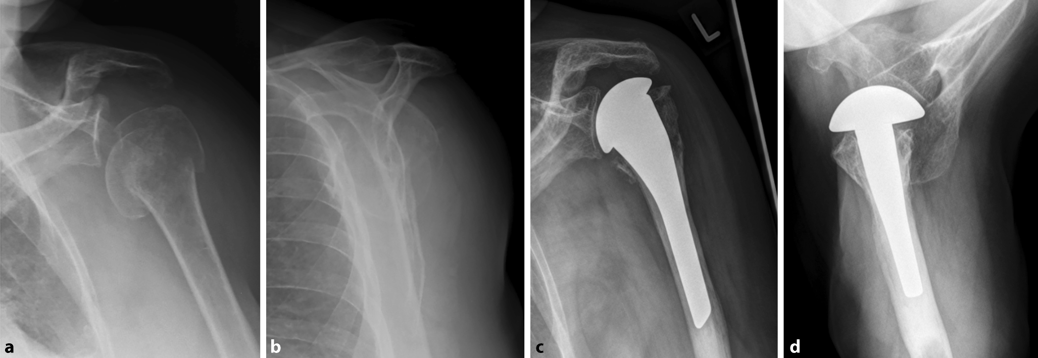 Head-split fractures of the proximal humerus | SpringerLink