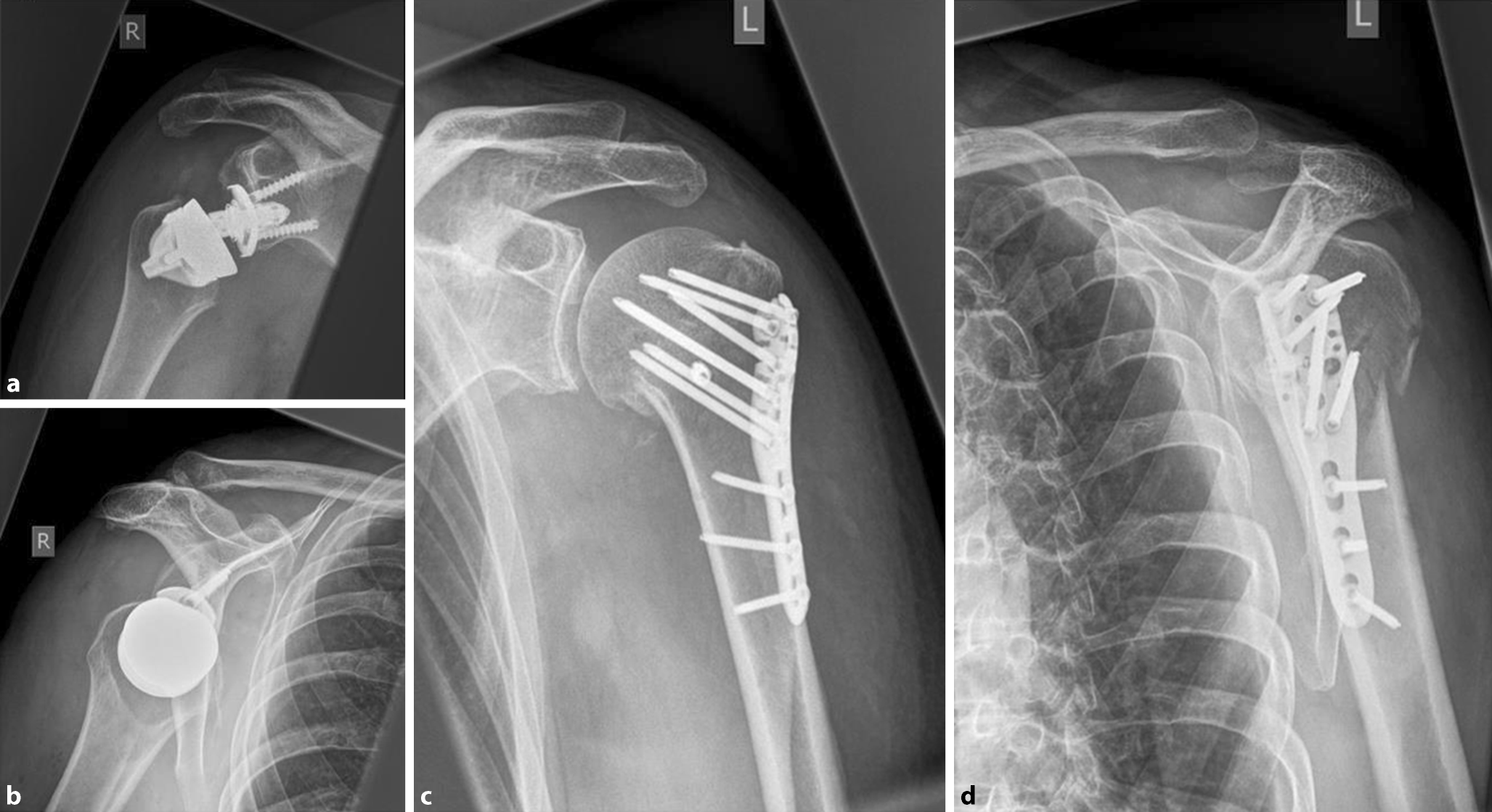 Posterior fracture dislocation of the proximal humerus | SpringerLink