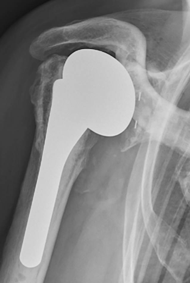 Risk factors for loosening of cemented glenoid components in anatomical ...