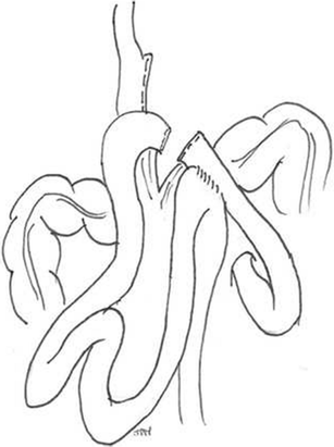 Comparison of Marginal Ulcer Rates Between Antecolic and Retrocolic ...