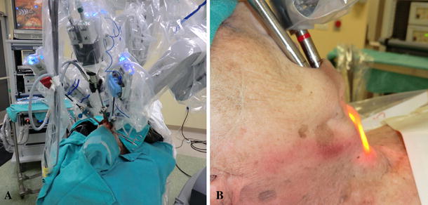 Transoral robotic-assisted thyroidectomy with central neck dissection ...