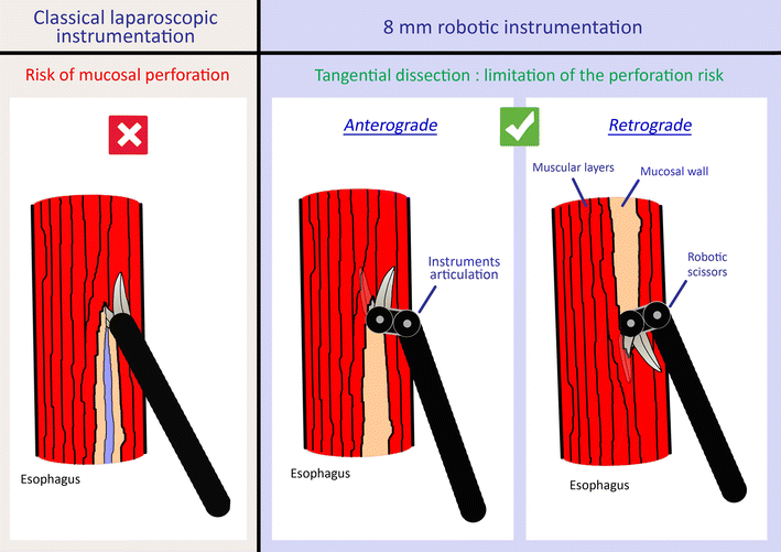 How robotic-assisted surgery can decrease the risk of mucosal tear ...