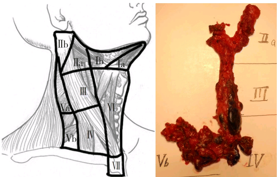 Robotic lateral cervical lymph node dissection via bilateral axillo ...
