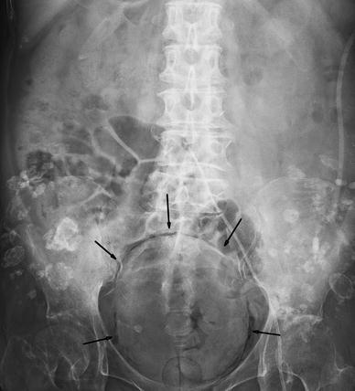 Gas around the bladder | SpringerLink