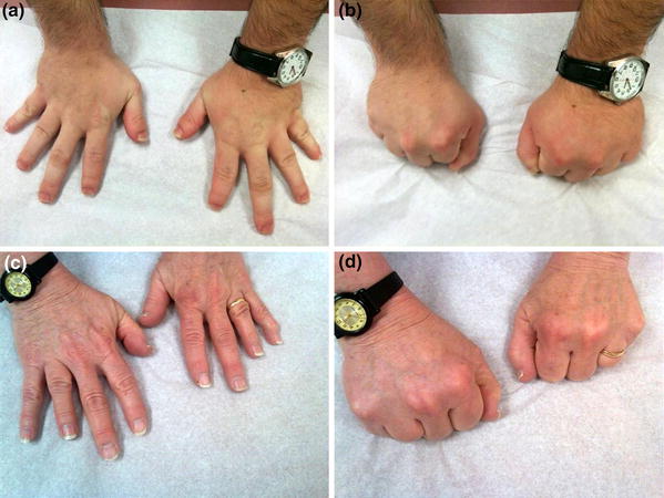 Albright’s hereditary osteodystrophy | SpringerLink