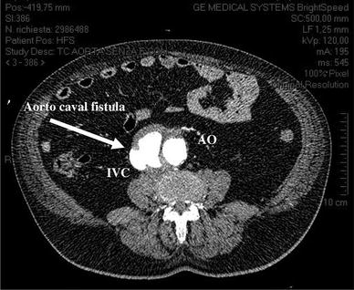 Aortocaval fistula | SpringerLink