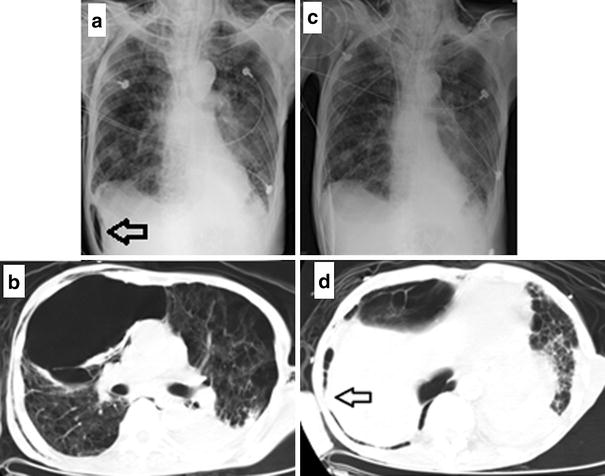 The deep sulcus sign indicates free air in the abdomen | SpringerLink