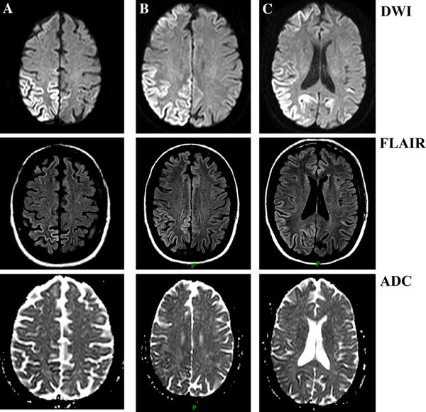 An ominous radiographic feature: cortical ribbon sign | SpringerLink