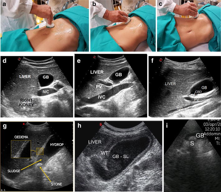 Update on bedside ultrasound (US) diagnosis of acute cholecystitis (AC ...