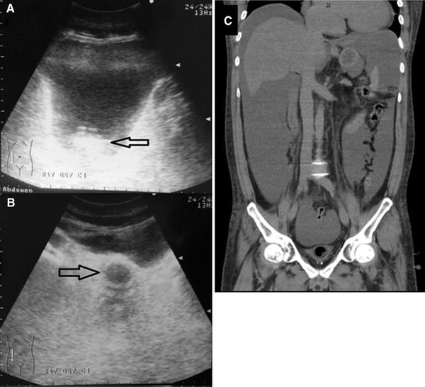 Massive ascites mimicking acute urinary retention | SpringerLink
