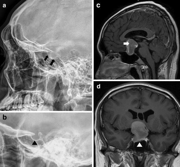 Double sellar floor sign: a clue of pituitary tumor | SpringerLink