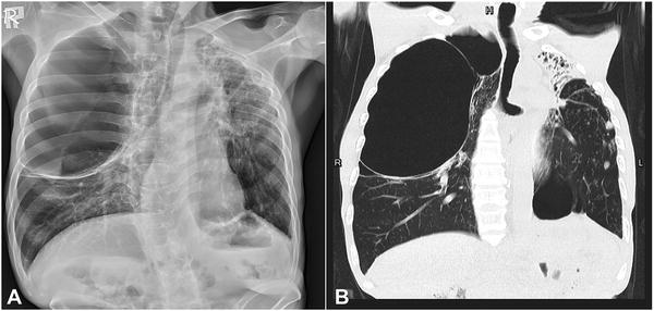 Tuberculosis-related giant bullae mimicking tension pneumothorax ...