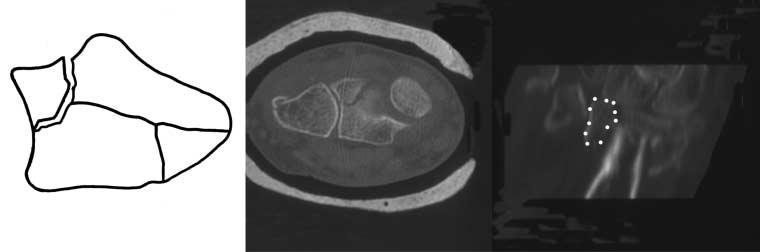 The treatment of severely comminuted intra-articular fractures of the ...