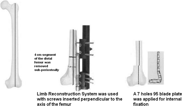External fixator-assisted acute shortening with internal fixation for ...