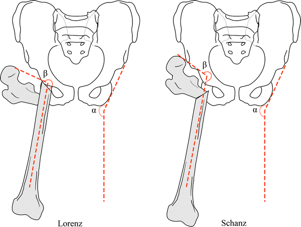 The pelvic support osteotomy: indications and preoperative planning ...