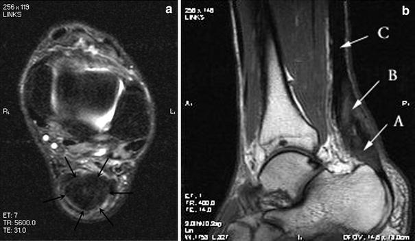 Neglected Achilles tendon rupture with central insertional plantaris ...