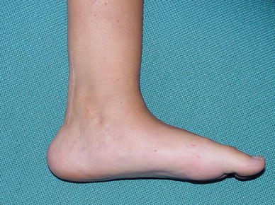 Correction of poliomyelitis foot deformities with Ilizarov method ...