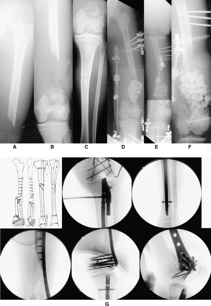 Management of the mangled extremity | SpringerLink
