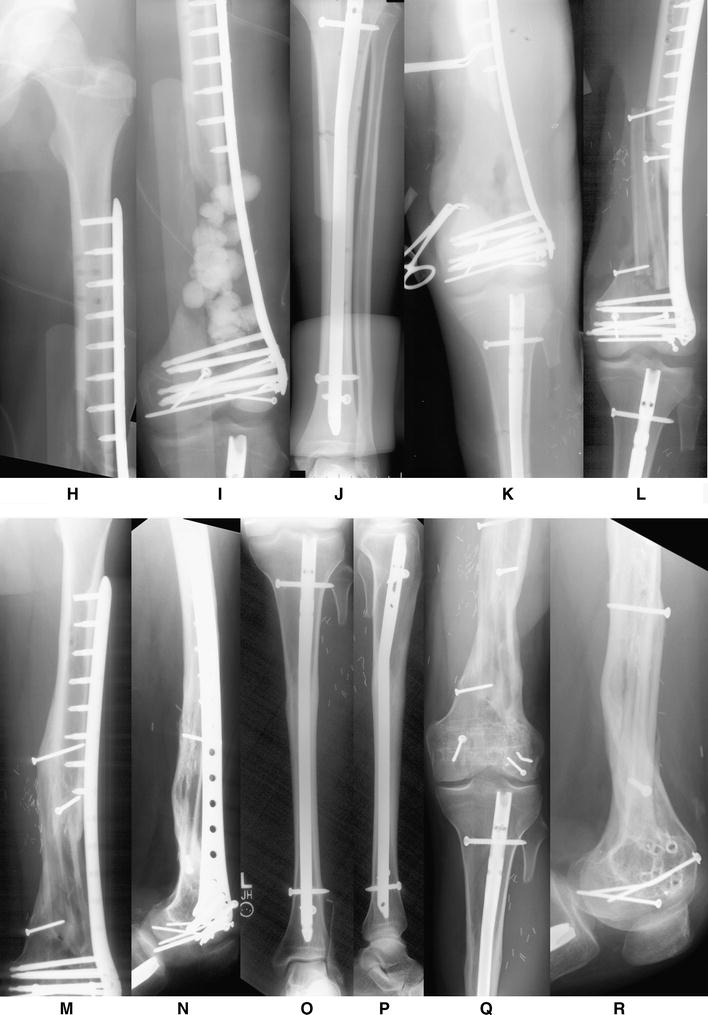 Management of the mangled extremity | SpringerLink