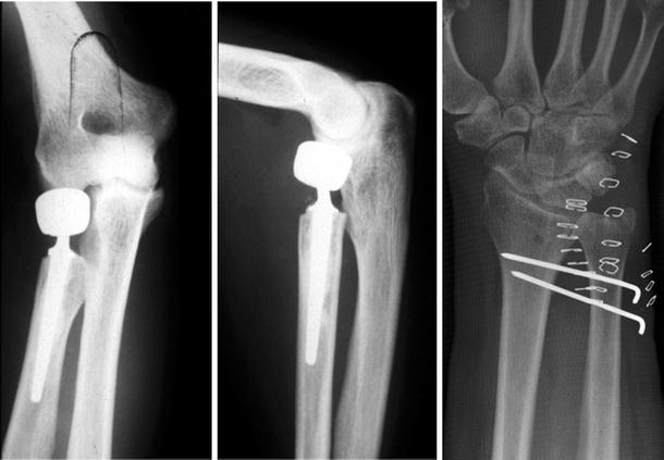 The Essex-Lopresti lesion | SpringerLink