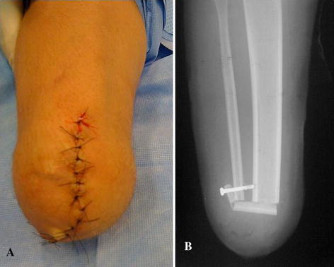 Cortical tibial osteoperiosteal flap technique to achieve bony bridge ...
