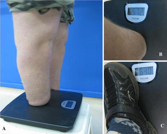 Cortical tibial osteoperiosteal flap technique to achieve bony bridge ...