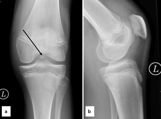 Arthroscopically assisted reduction and internal fixation of a femoral ...