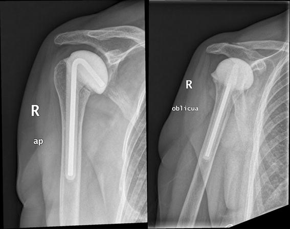 Antibiotic-impregnated cement spacer as a definitive treatment for post ...