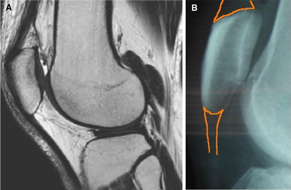 Percutaneous cerclage wiring for the surgical treatment of displaced ...