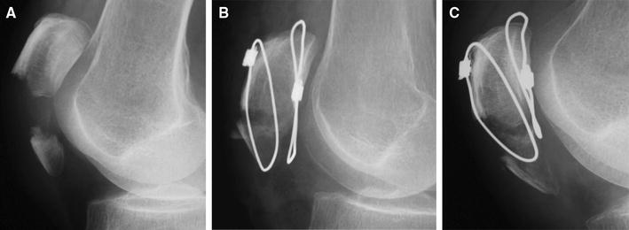 Percutaneous cerclage wiring for the surgical treatment of displaced ...