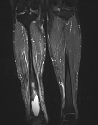 Adjuvant treatment of chronic osteomyelitis of the tibia following ...