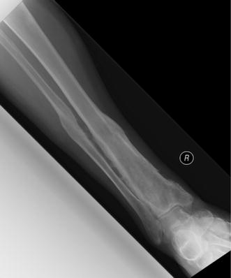 Adjuvant treatment of chronic osteomyelitis of the tibia following ...