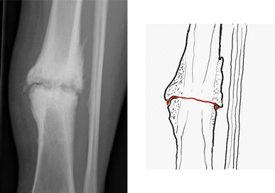 The callus fracture sign: a radiological predictor of progression to ...
