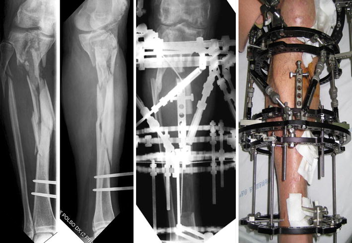 Distraction osteogenesis for tibial nonunion with bone loss using ...